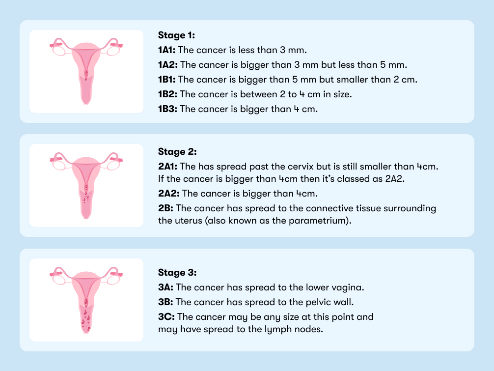 Cervical Cancer Stages